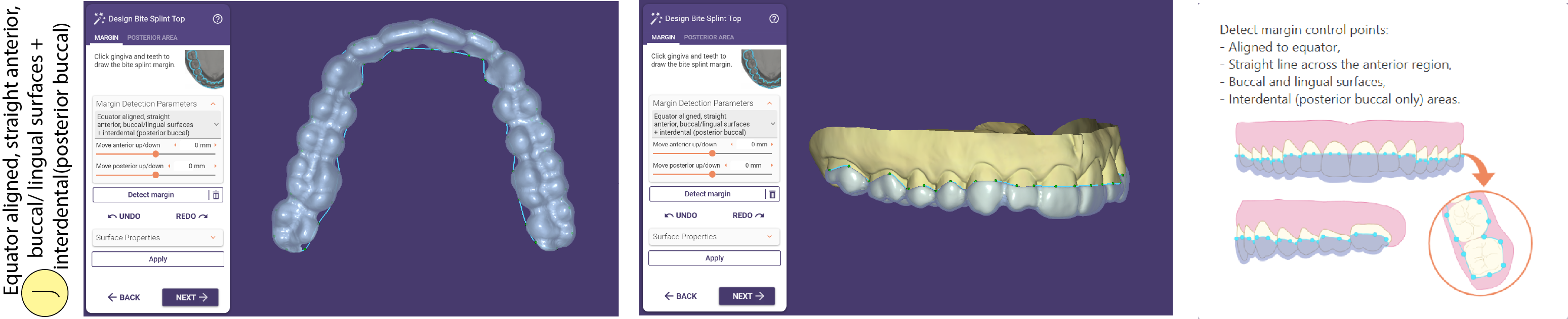 File:Bitesplint top J.png - exocad