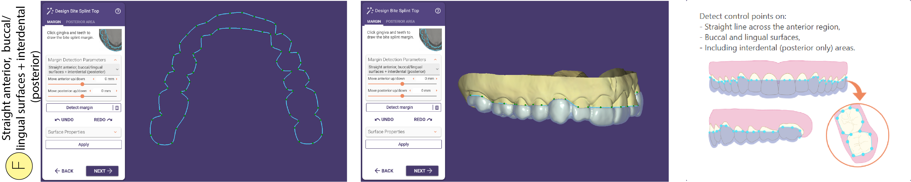 File:Bitesplint top F.png - exocad