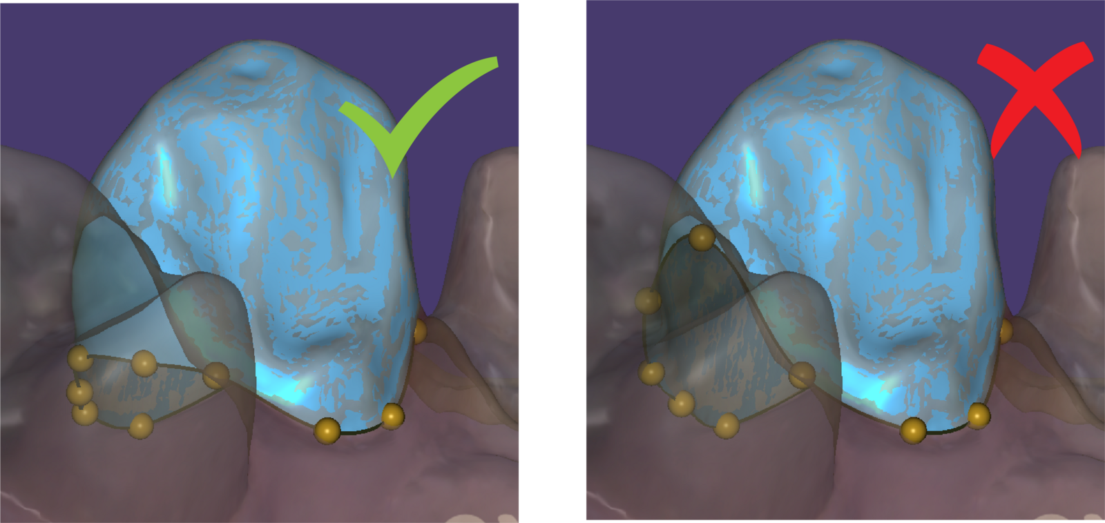 Provisional Crown Top - exocad