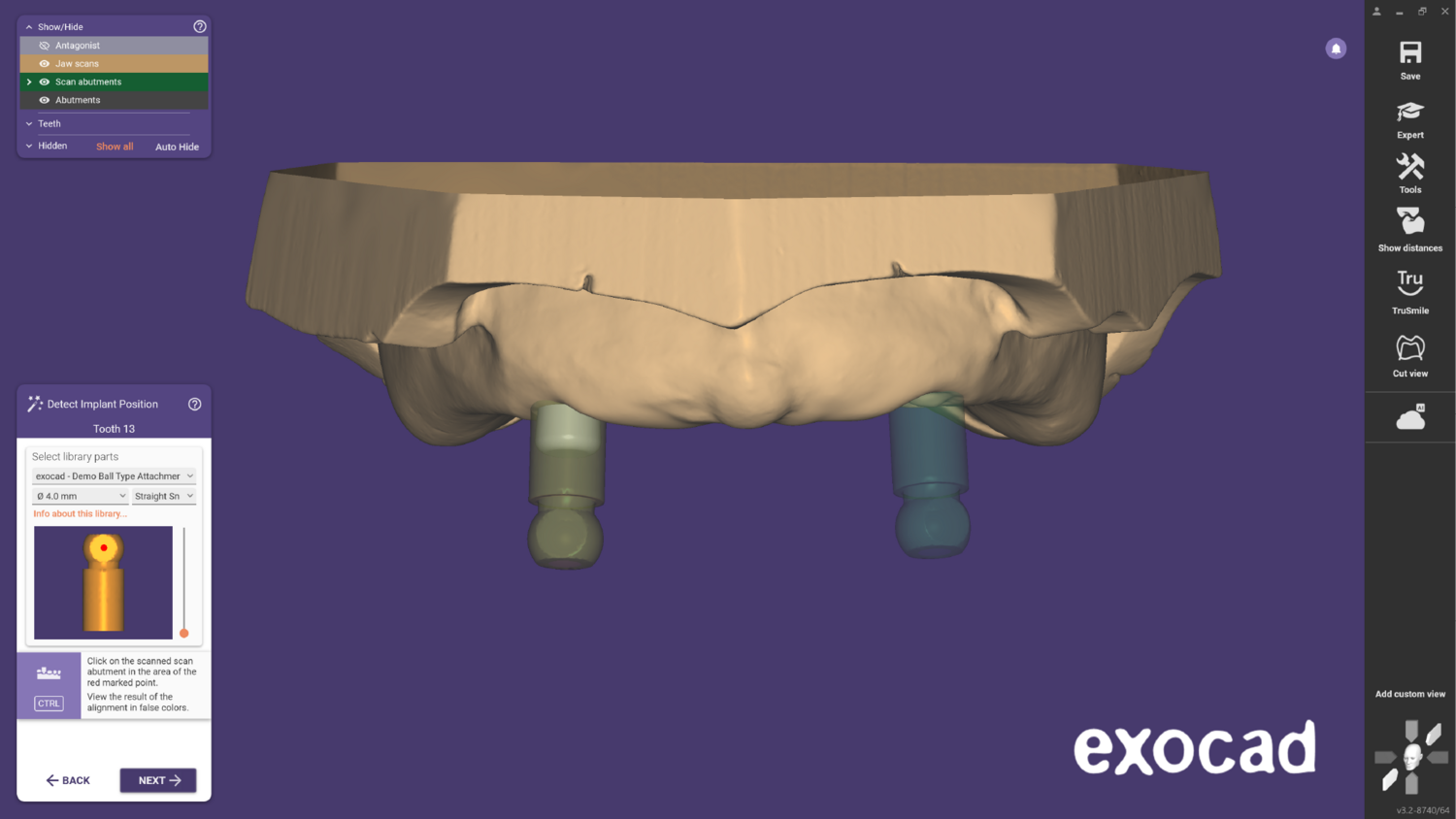 Overdenture on ball attachments - exocad