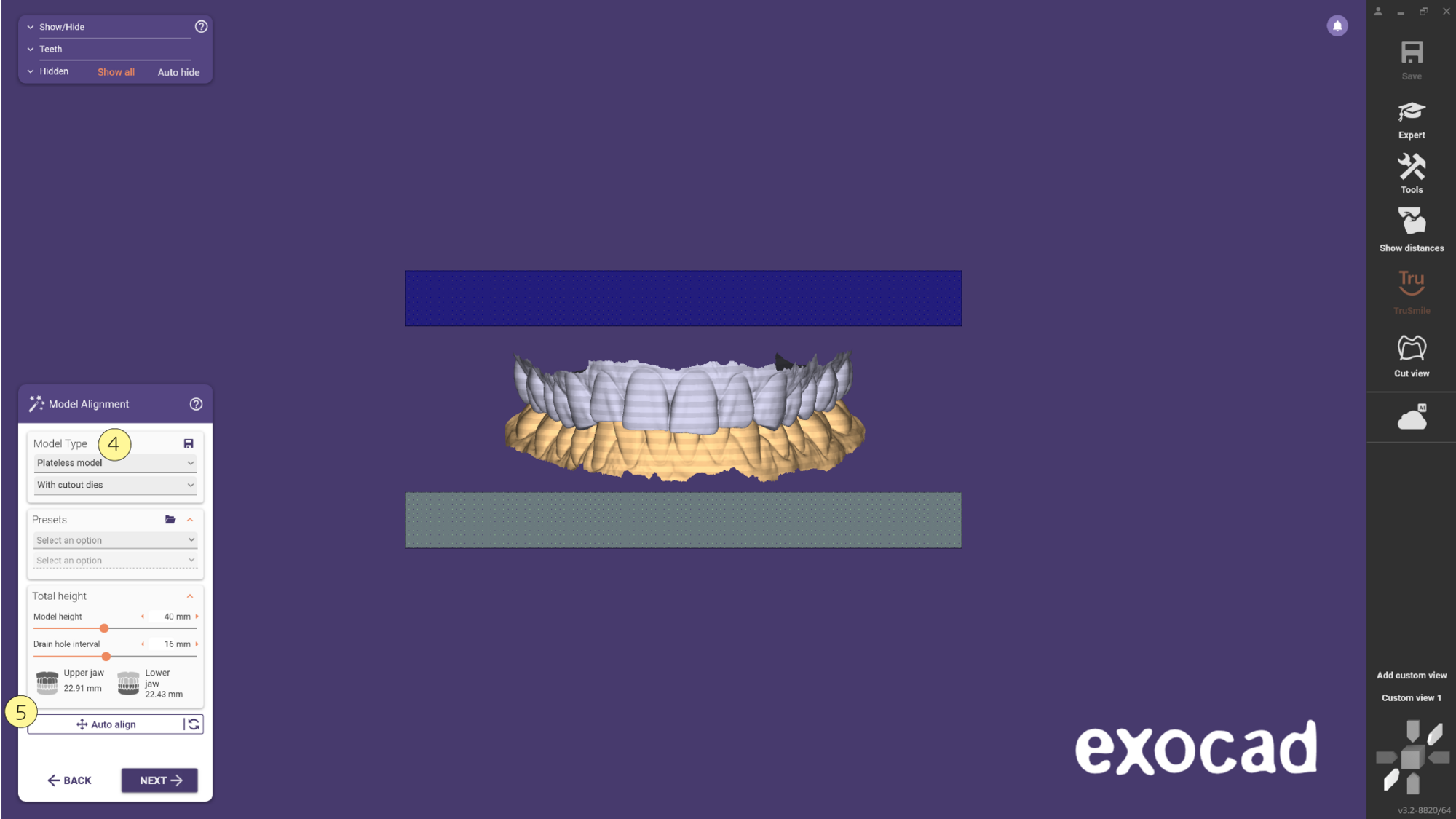 Provisional crown stump models - exocad
