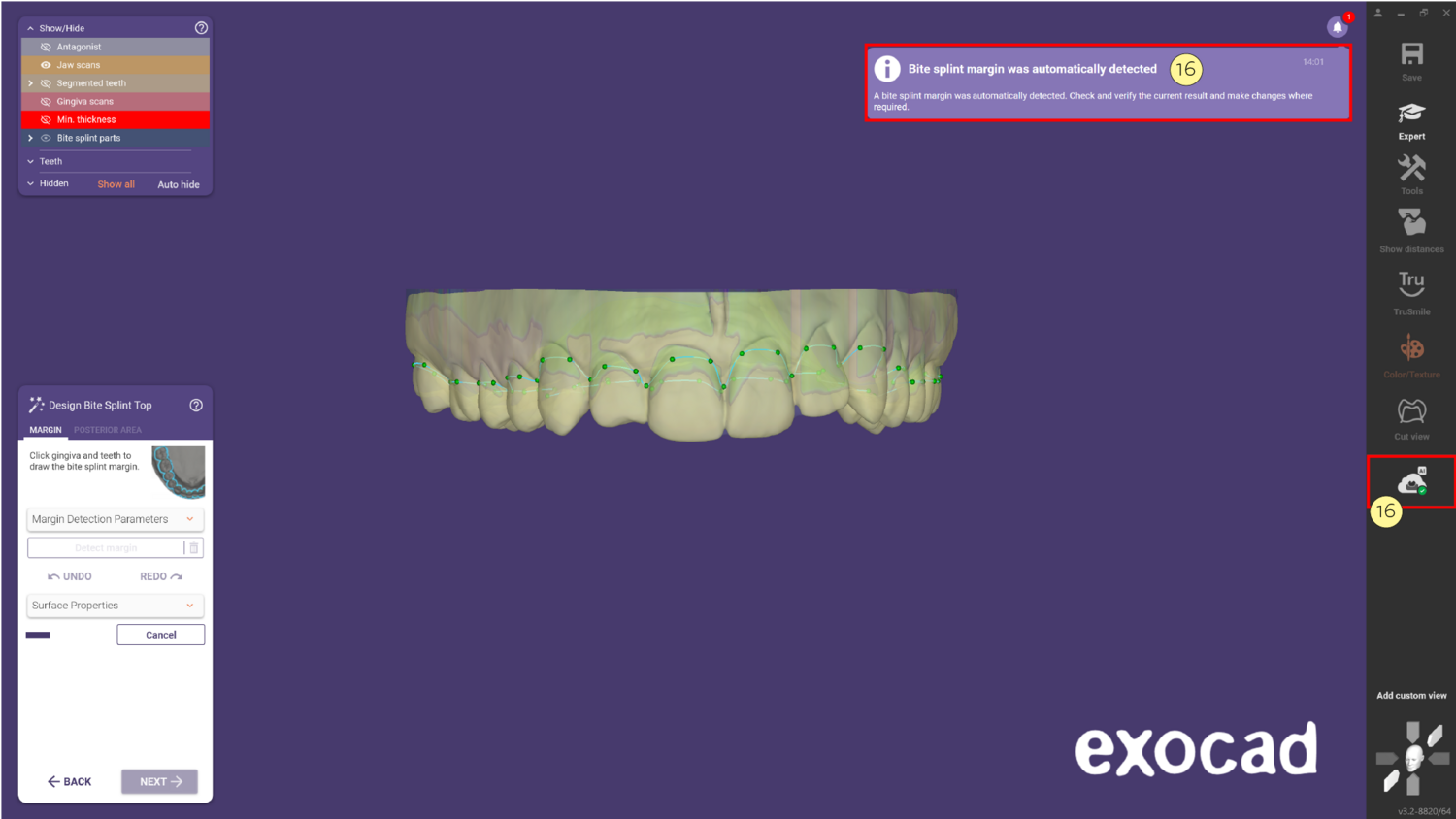 Bite Splint - exocad