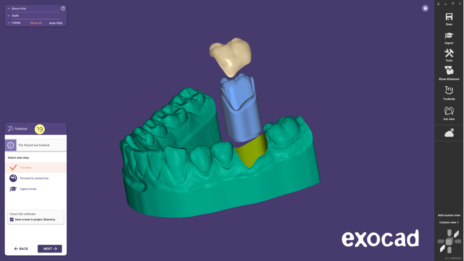 Provisional crown stump models - exocad