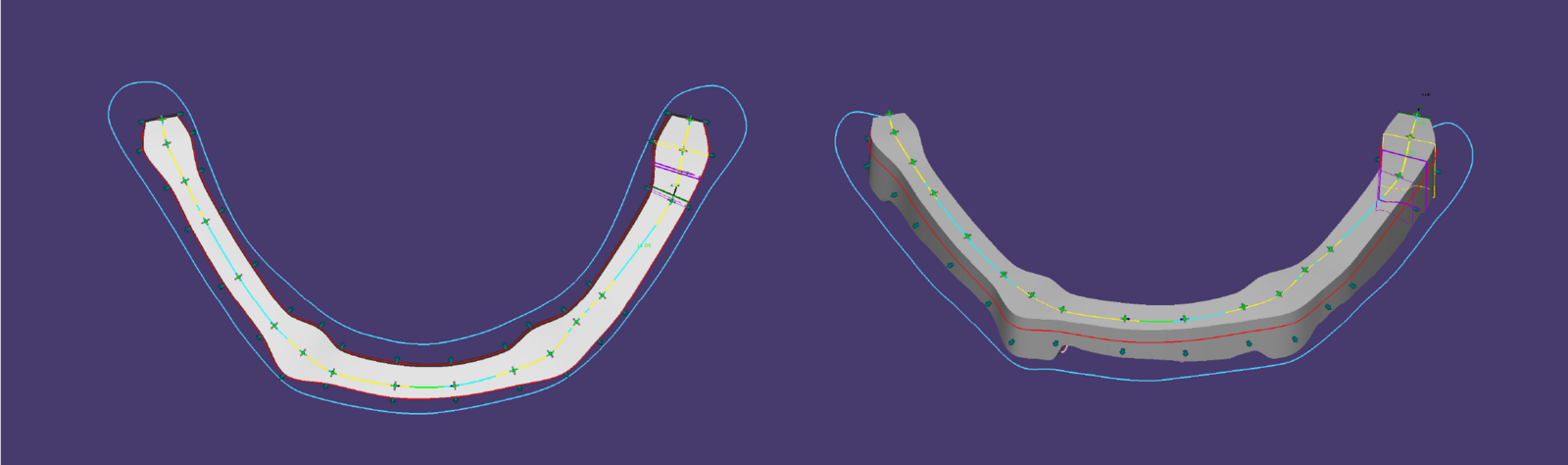Bar Module Split Bar - exocad