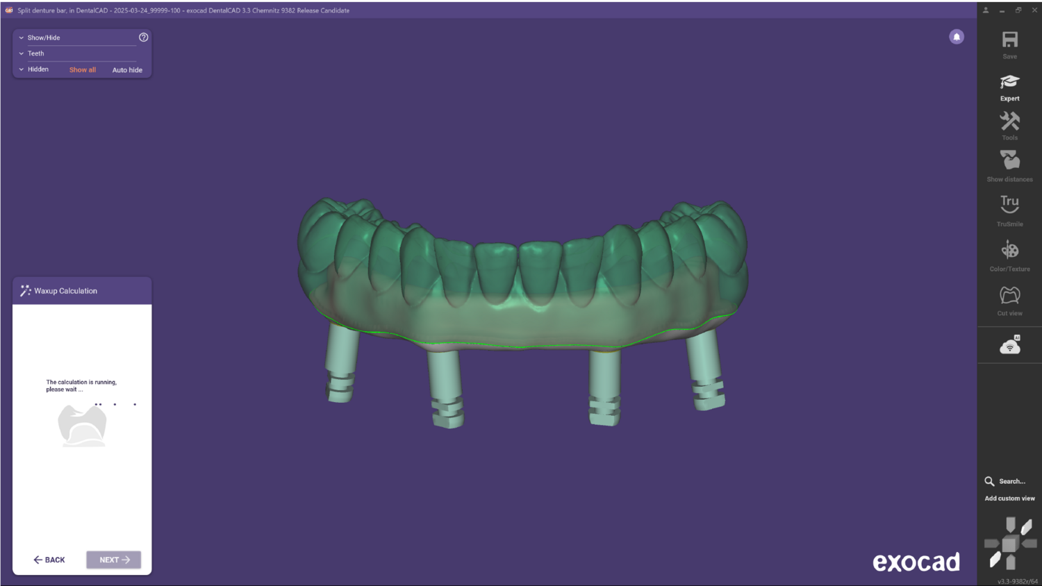Bar Module Split Bar - exocad