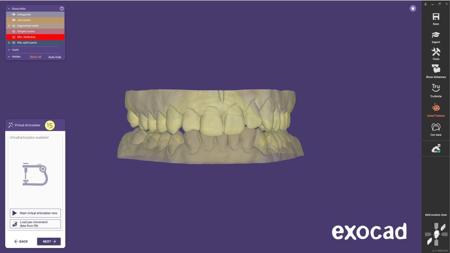 Bite Splint - exocad