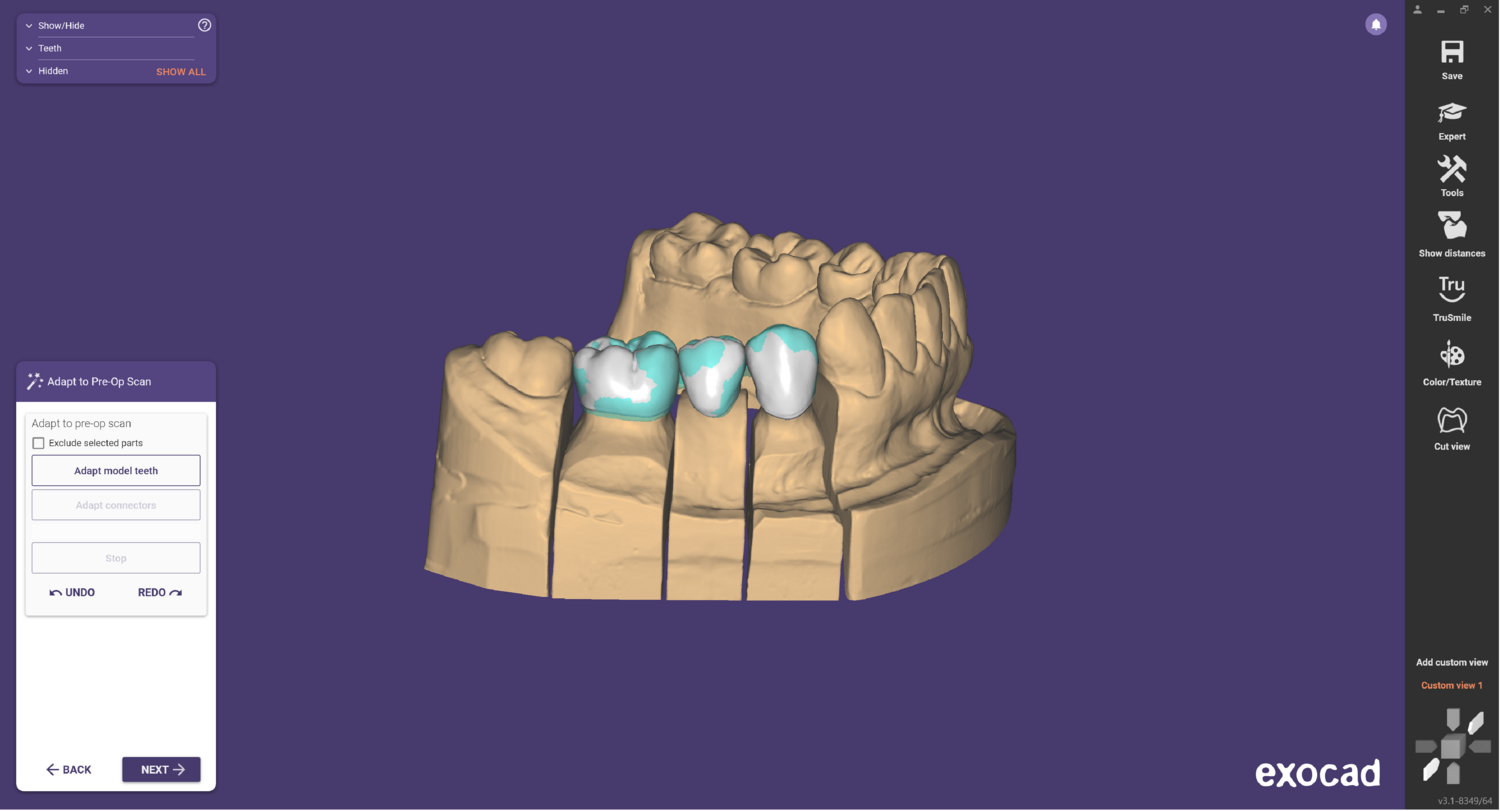 Understanding the difference between Pre-op and Waxup feature - exocad