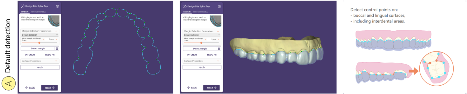 Design the bitesplint top - exocad