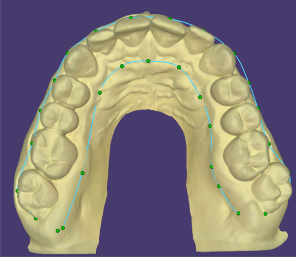 Design the bitesplint top - exocad