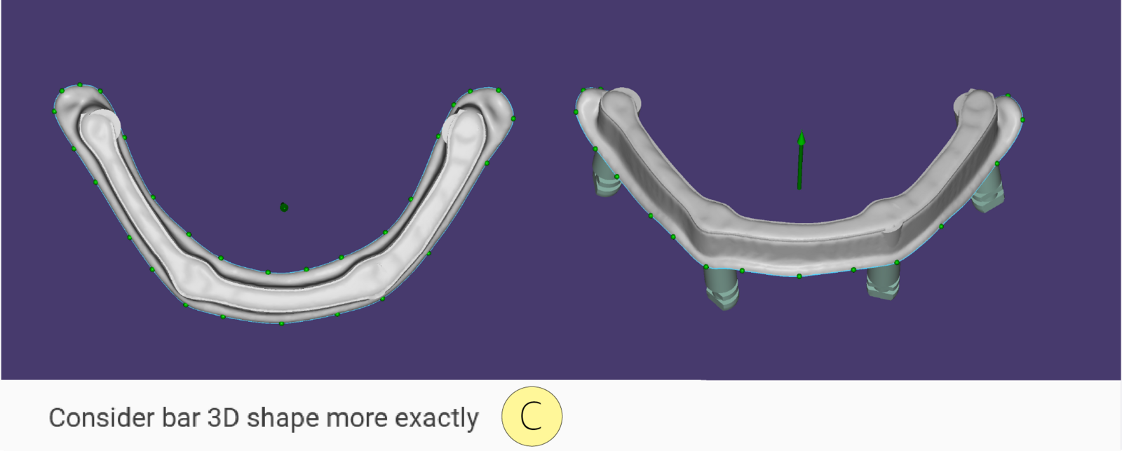 Bar Module Split Bar - exocad