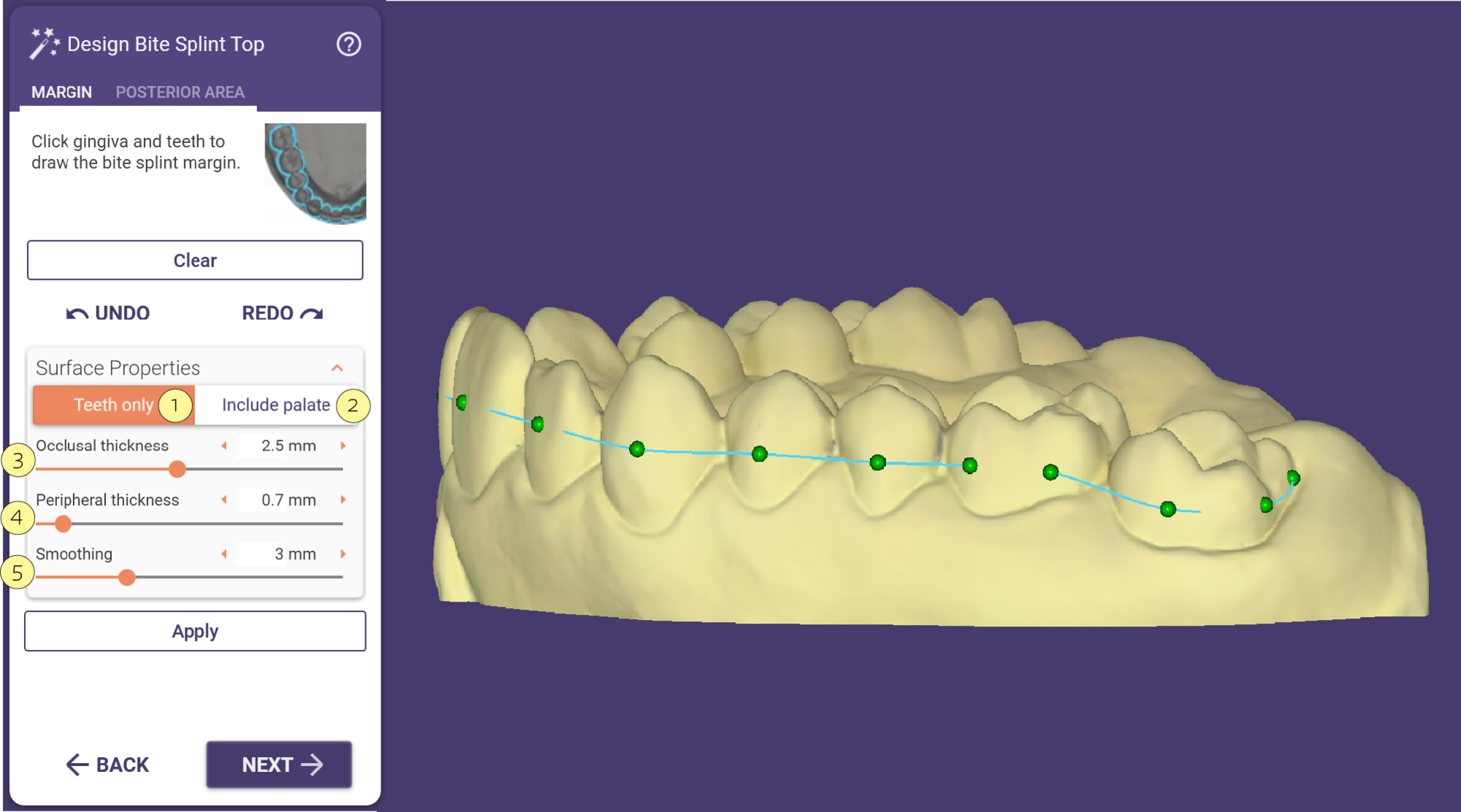 Design the bitesplint top - exocad