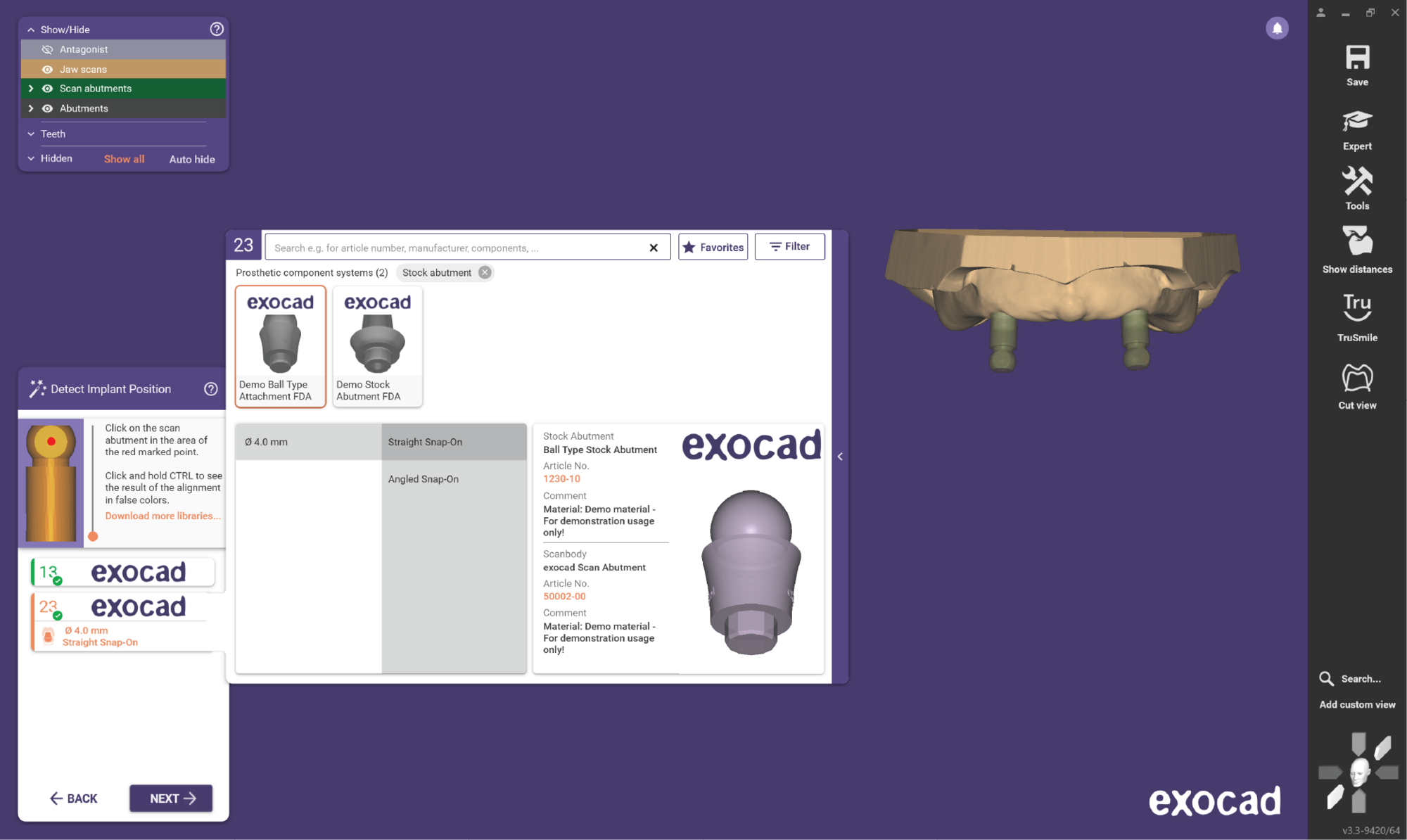 Overdenture on ball attachments - exocad