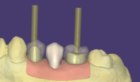 Abutment design - exocad