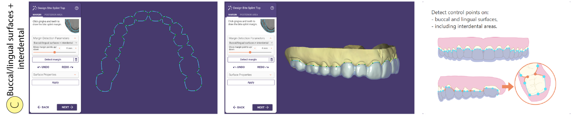 Design the bitesplint top - exocad