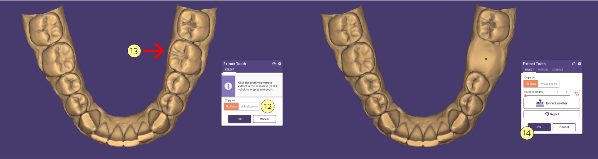 Provisional crown stump models - exocad