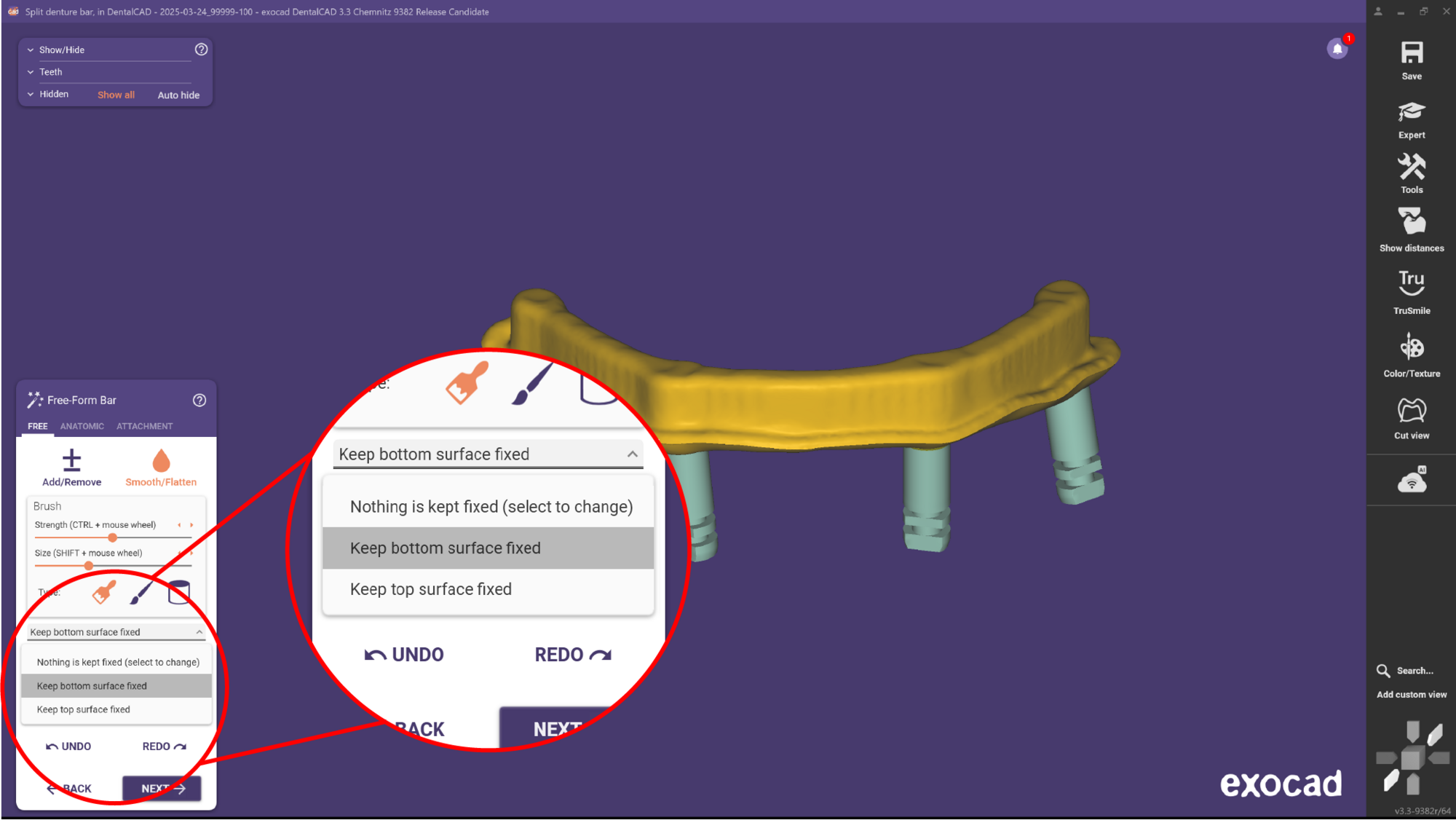 Bar Module Split Bar - exocad