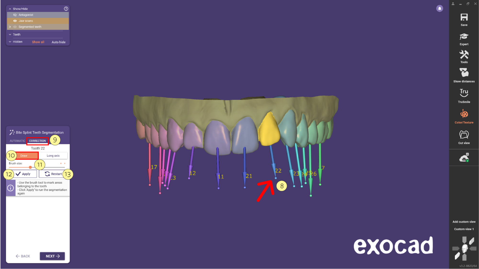 Bite Splint - exocad
