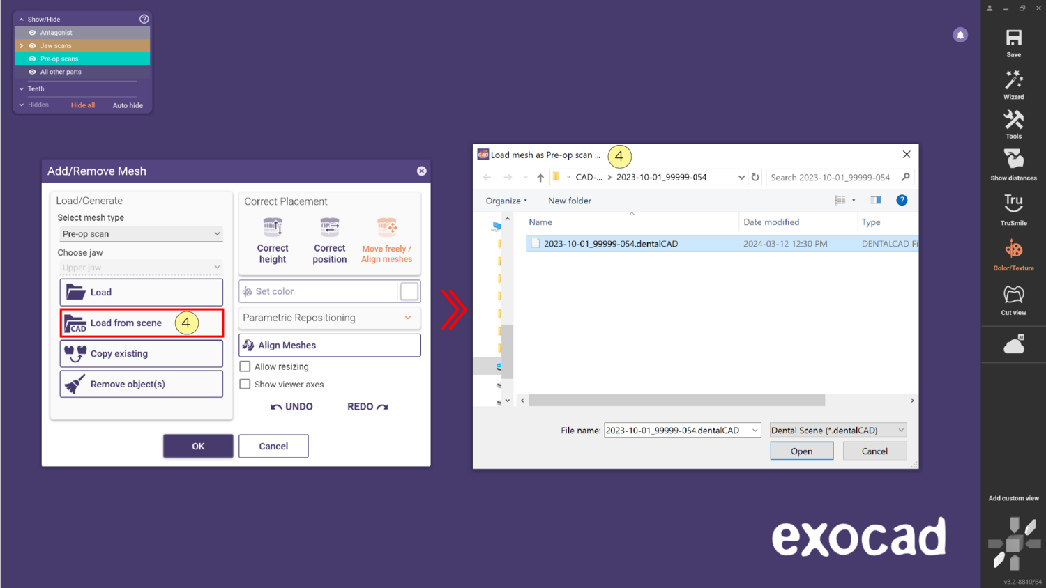 Add/Remove Mesh - exocad
