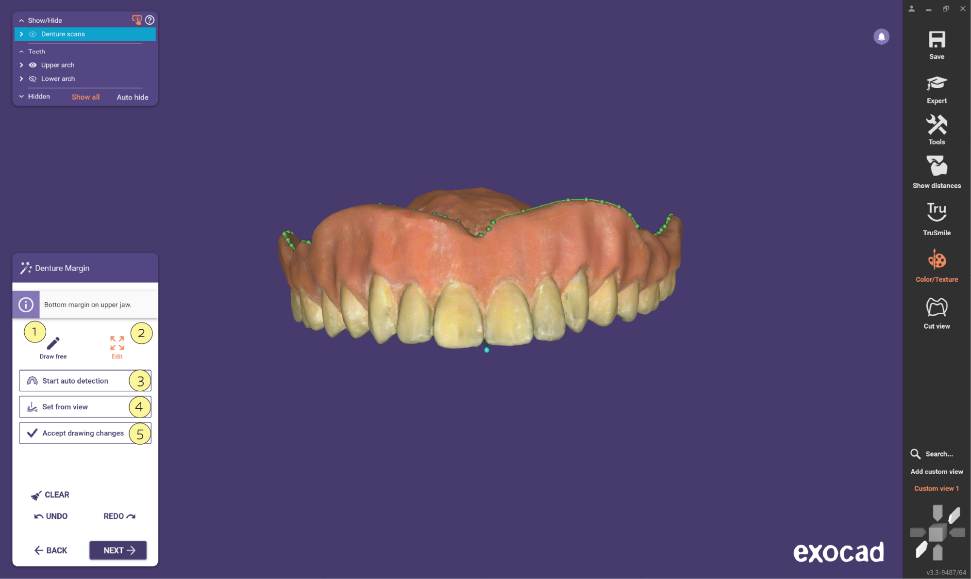 Duplicate denture - exocad