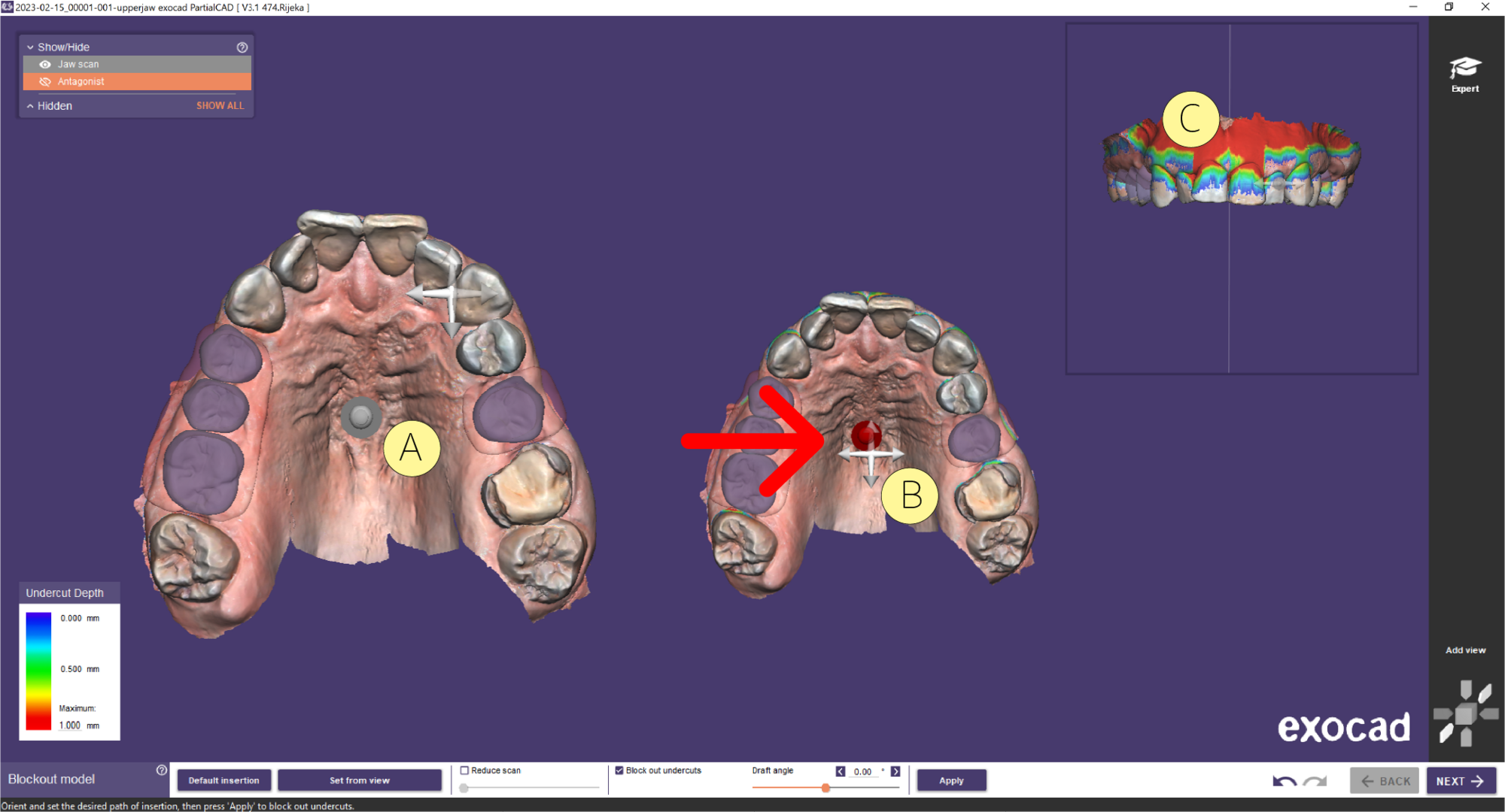 Partial Framework - Blockout model - exocad Partial Framework - Blockout model - exocad