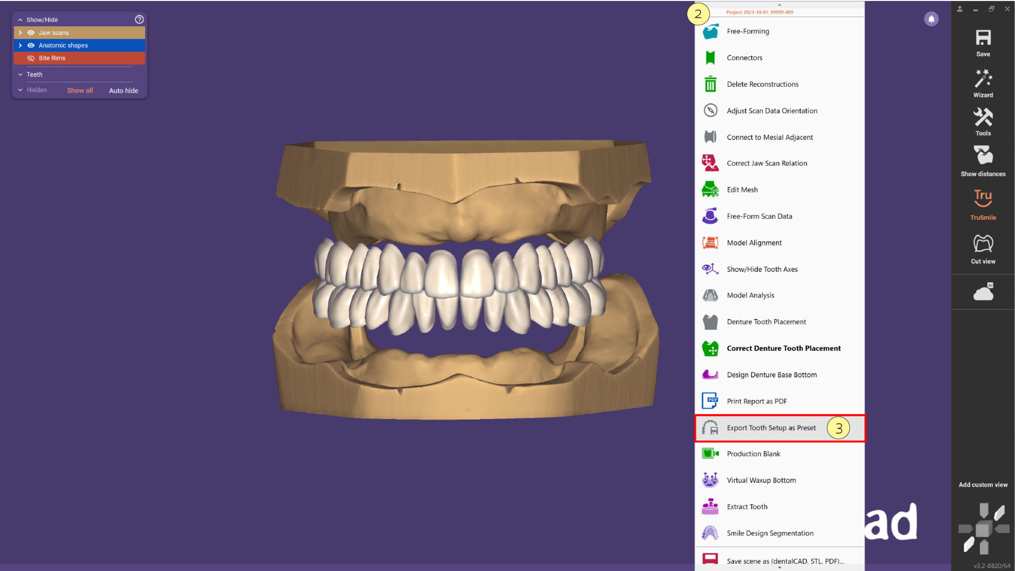 Denture tooth placement - exocad