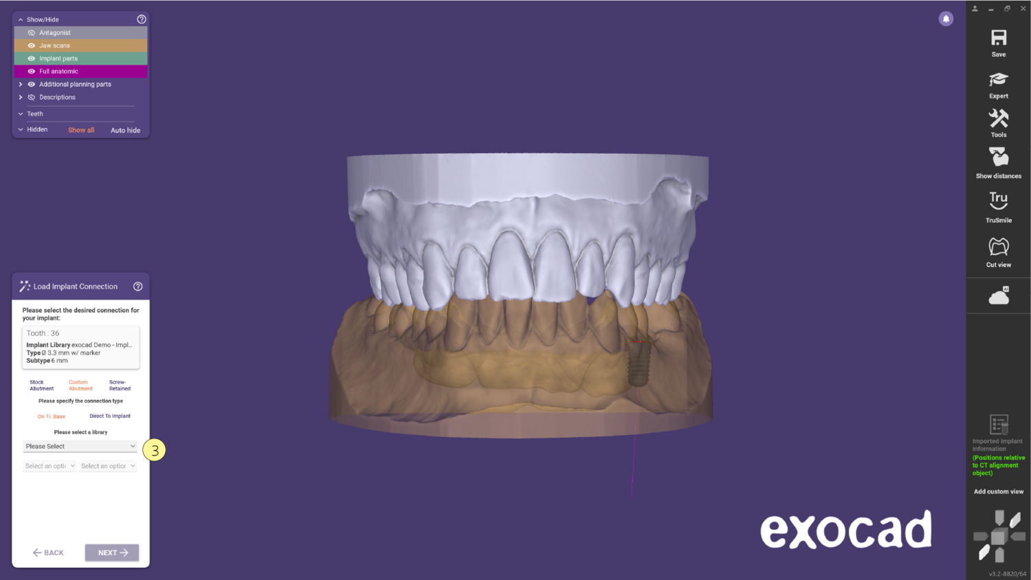Load abutment support for planned implants - exocad